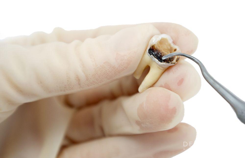 De La Caries Al Cáncer Oral Una Guía Completa De Las Enfermedades De